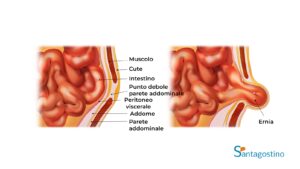Ernia addominale: cause, sintomi e trattamento - Santagostino Monza